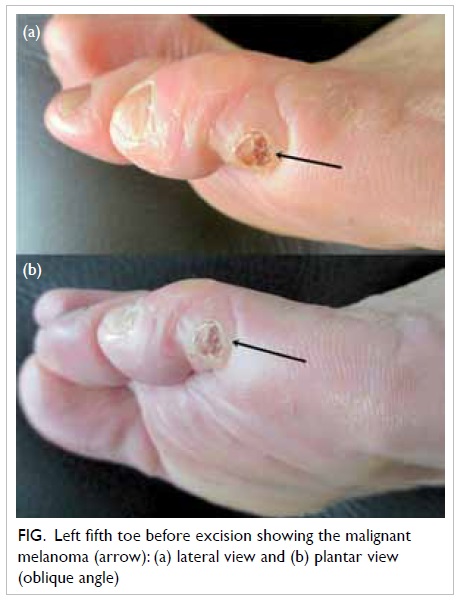 Amelanotic melanoma masquerading as a pyogenic granuloma: caution ...